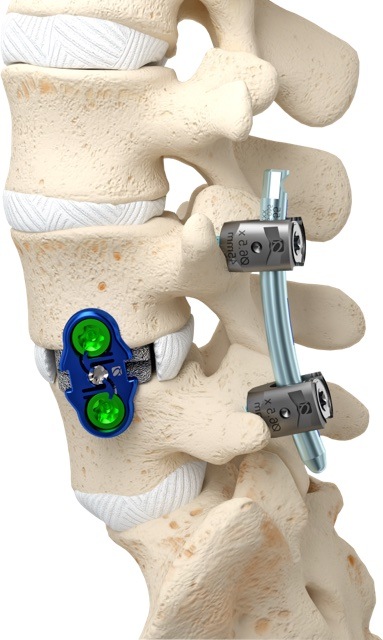Lumbar Fusion | Benjamin Ditty M.D.