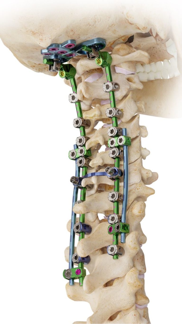Posterior Cervical Decompression and Fusion | Benjamin Ditty M.D.