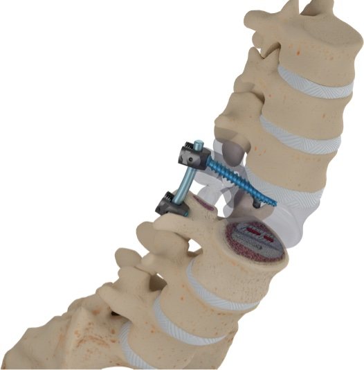Lumbar Fusion | Benjamin Ditty M.D.